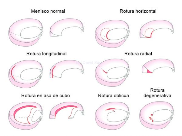 Lesiones de Menisco. Rehabilitación Tras Intervención Quirúrgica